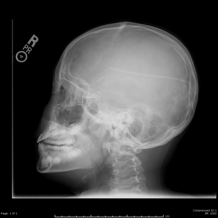 CHOC intraventricular hemorrhage and hydrocephalus patient accepted to ...