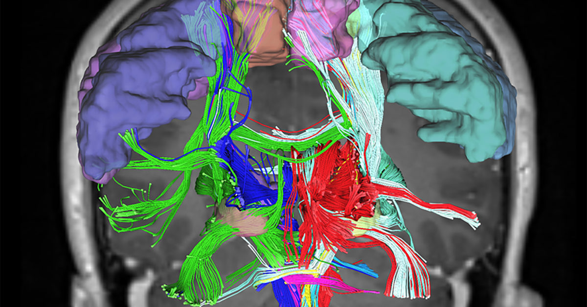 Precision 3D neuroimaging better pinpoints epileptogenic foci