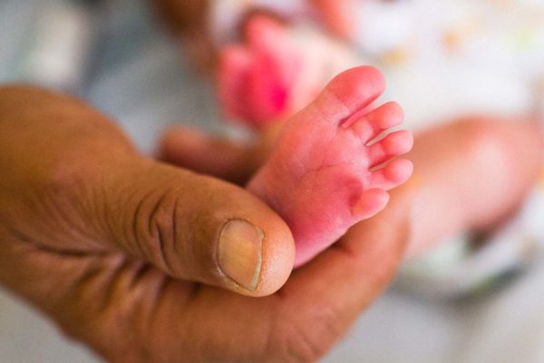 Treating neonatal arteriovenous malformation with surgery